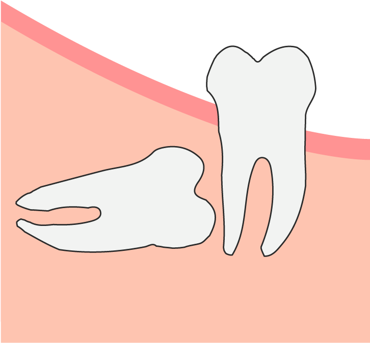 Horizontal Wisdom Tooth Impaction Clipart - Full Size Clipart (#1507087 ...