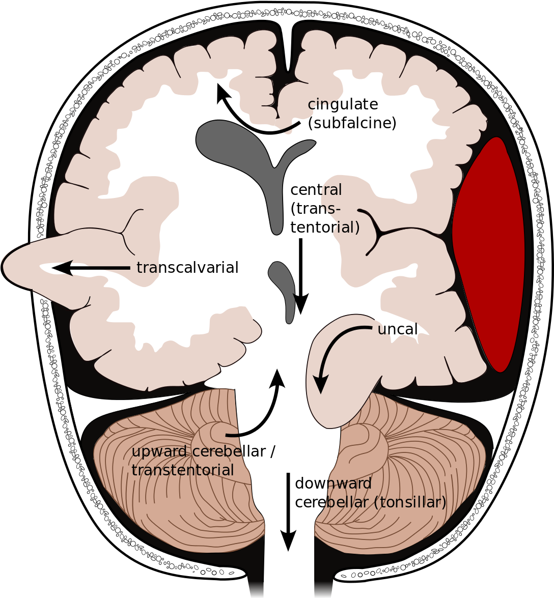 Brain Herniation Types-2 - Types Of Brain Herniation Clipart - Full ...