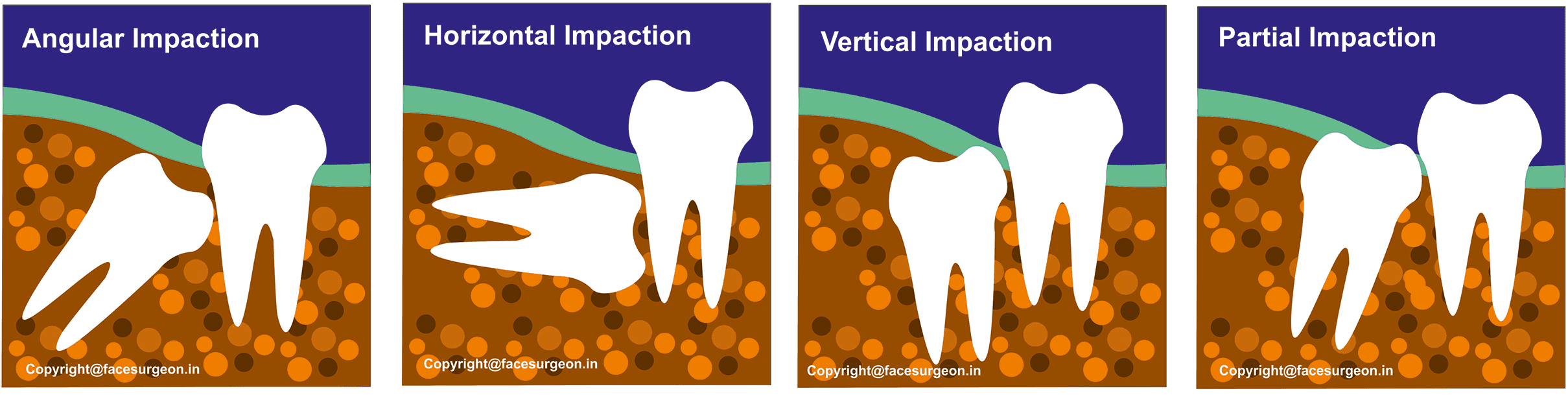 Different Types Of Impaction Clipart - Full Size Clipart (#2309129 ...