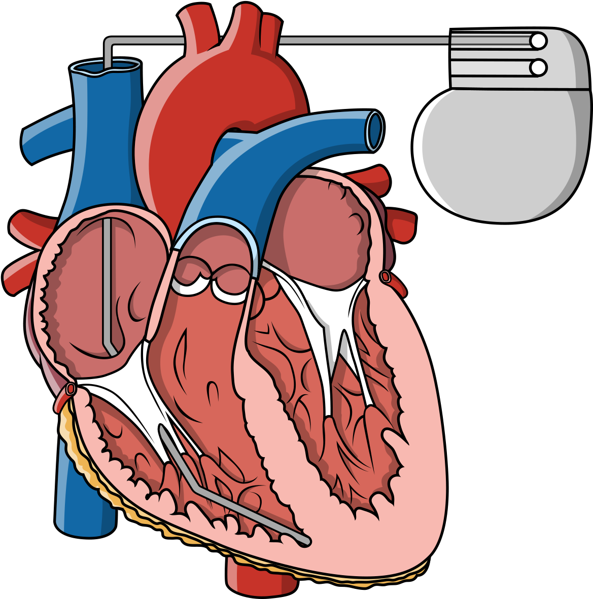 Download Pacemaker Information And Support Pt 2 Survey Clipart ...