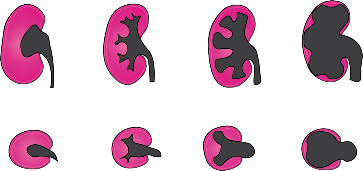 Acute Vs Chronic Hydronephrosis Clipart - Full Size Clipart (#3269349 ...