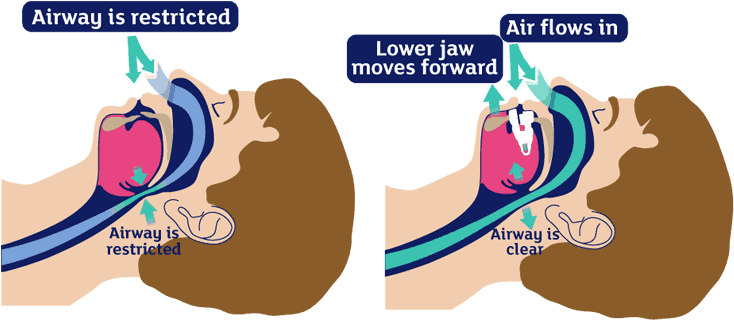 Download Loud Snoring And Obstructive Sleep Apnoea - Graphic Design ...