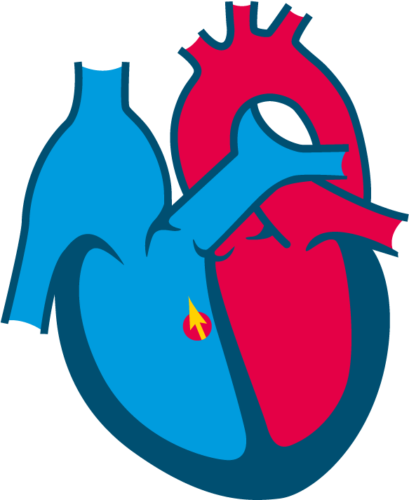 Perimembranous Vsd Clipart - Full Size Clipart (#3871427) - PinClipart