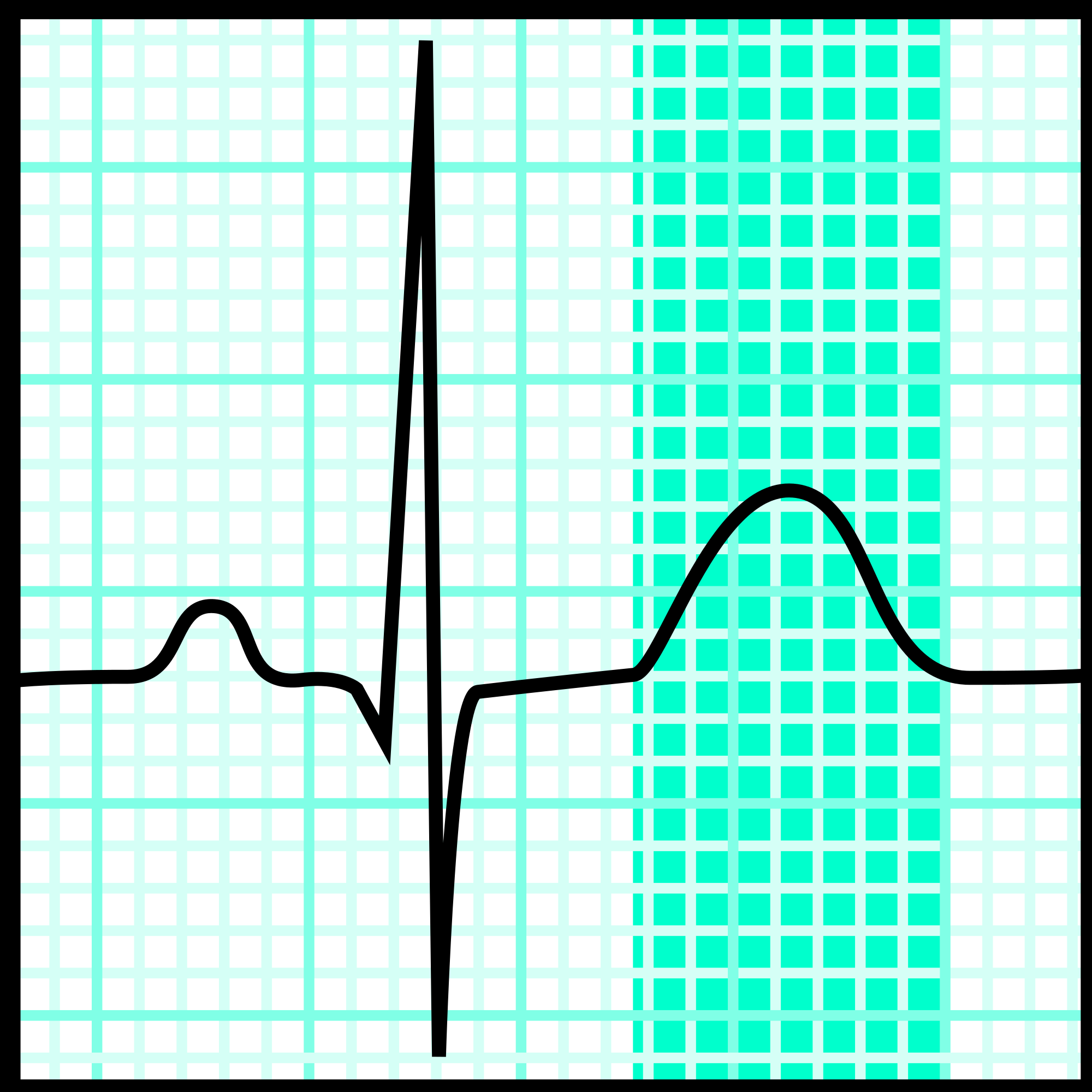 Rn Ecg Svg - Normal T Wave In Ecg Clipart - Full Size Clipart (#4953805 ...