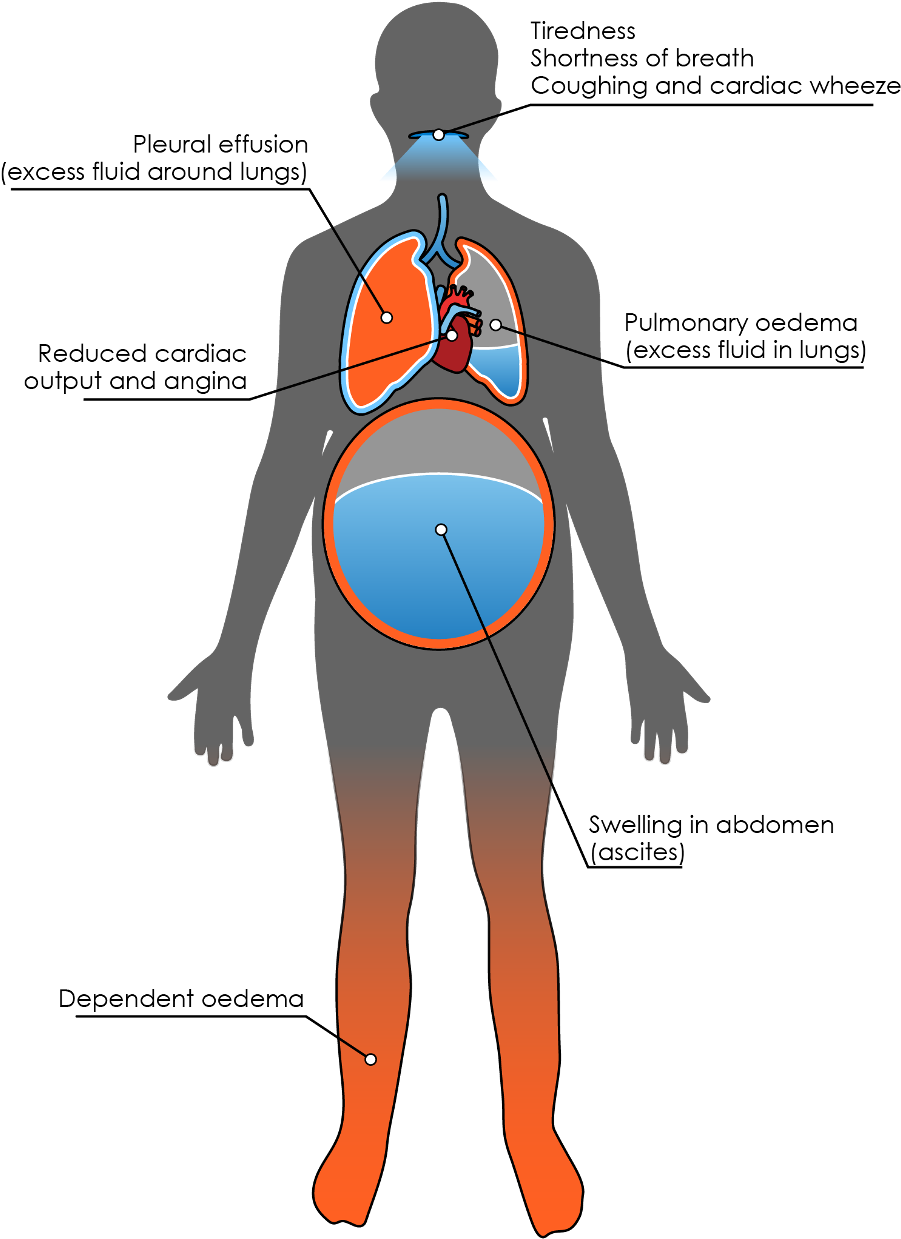 Download Transparent Shortness Of Breath Clipart - Heart Failure Edema ...