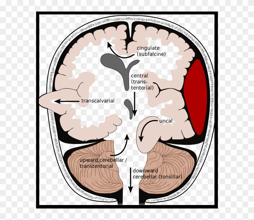 Uncal Herniation Brain Herniation Syndrome Uncal