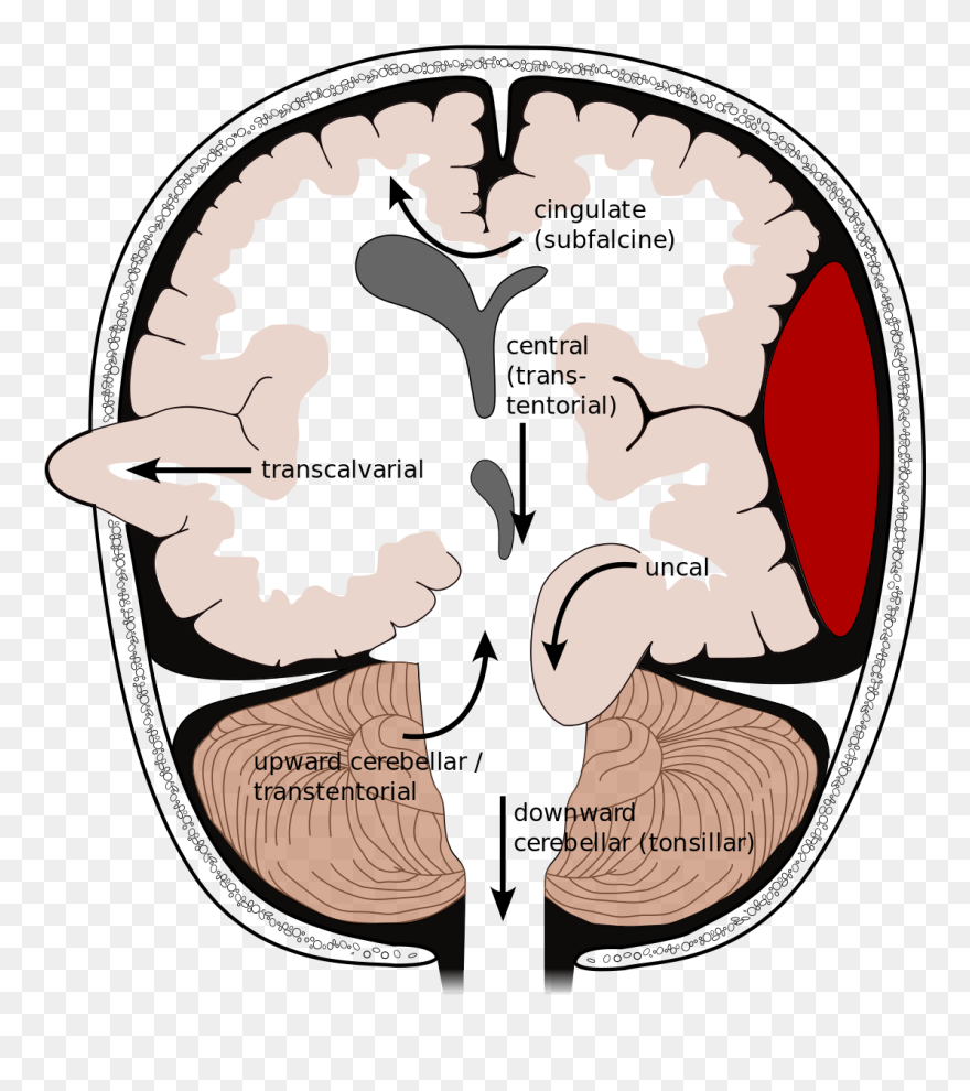 Brain Herniation Types-2 - Types Of Brain Herniation Clipart (#218077 ...