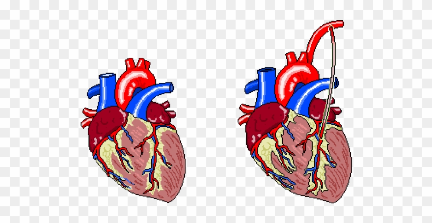 Lima Bypass Graft - Coronary Artery Bypass Surgery Clipart (#2202871 ...