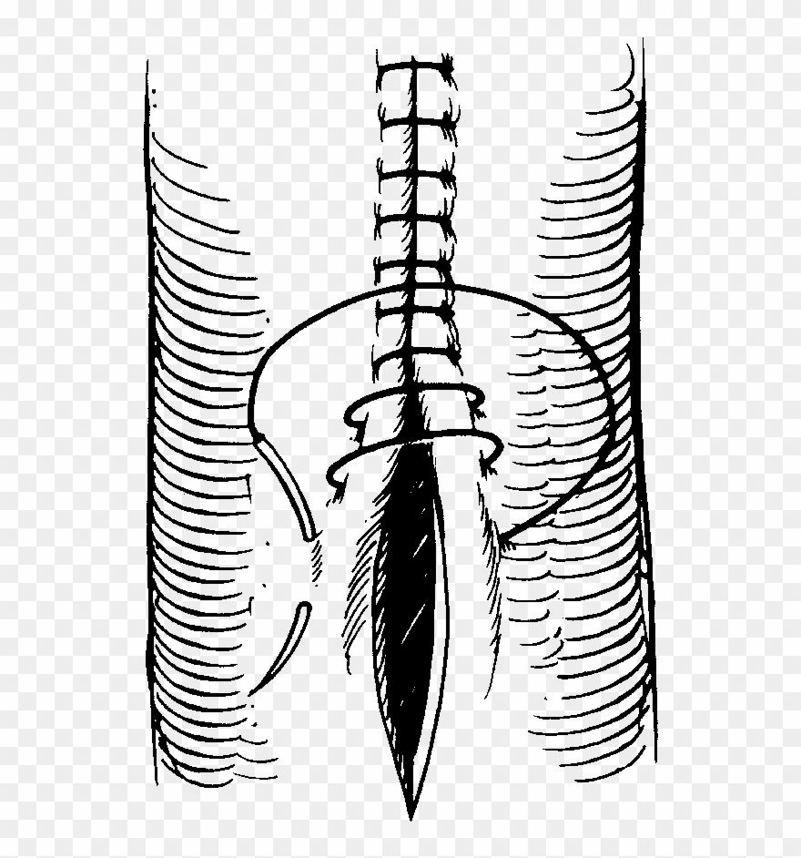 Download Suture Placement Is Well Away From The Incision Margin Clipart ...