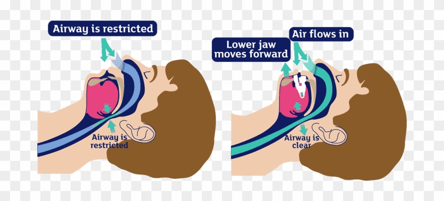 Loud Snoring And Obstructive Sleep Apnoea - Graphic Design Clipart ...