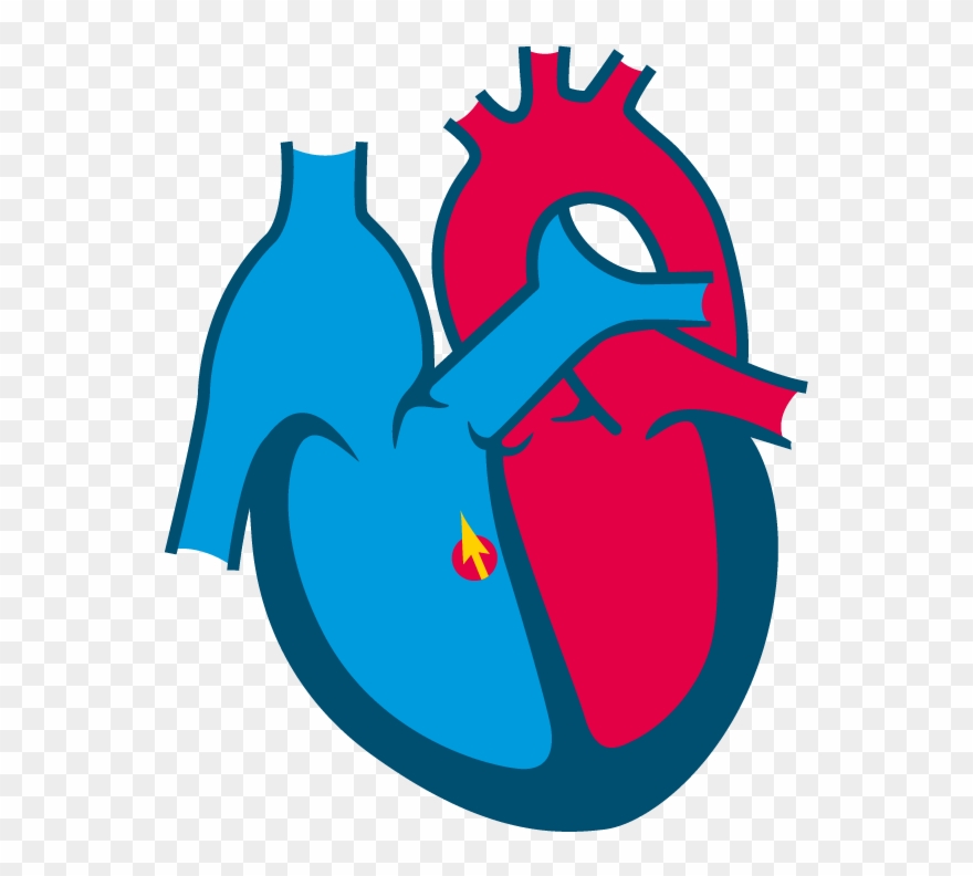 Perimembranous Vsd Clipart (#3871427) - PinClipart