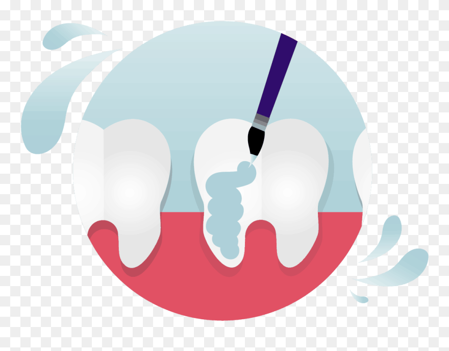 Applying Topical Fluoride To Protect Tooth Enamel - Graphic Design ...