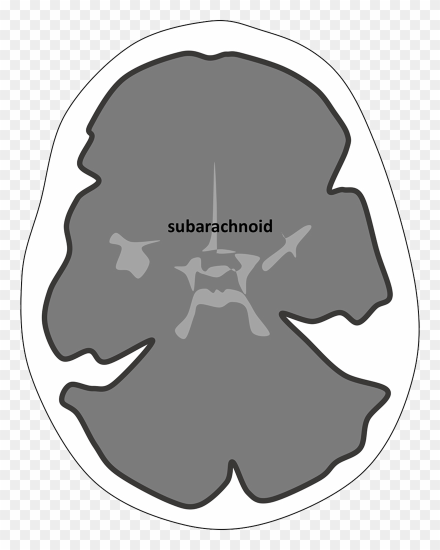 Diagram Showing The Appearance Of Subarachnoid Haemorrhage ...